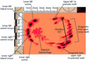 Chapter 9: Recognition of Physical Abuse detail – RCPCH Child ...